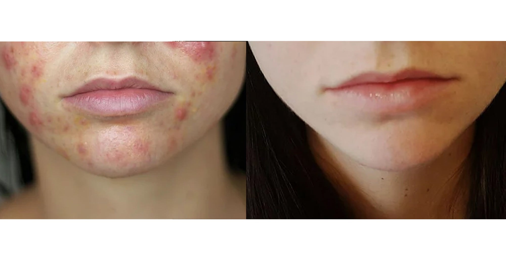 Can You Use Spironolactone to Treat Acne? | PS UK Beauty
