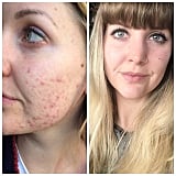 Acne Before and After Transformations | POPSUGAR Beauty UK