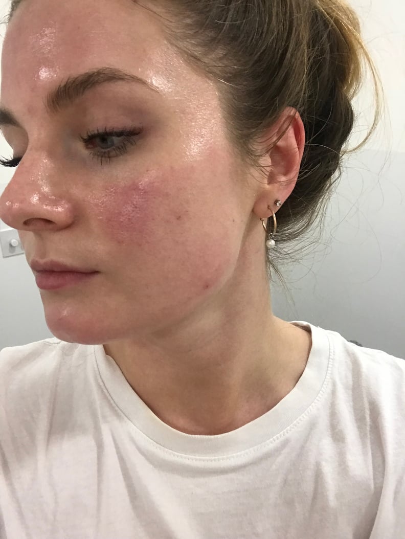 How to Treat Broken Capillaries on the Face | PS UK Beauty