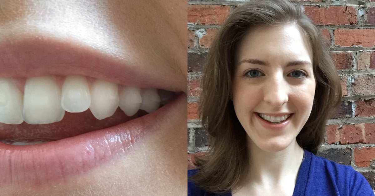 Pros and Cons of Invisalign | PS Beauty