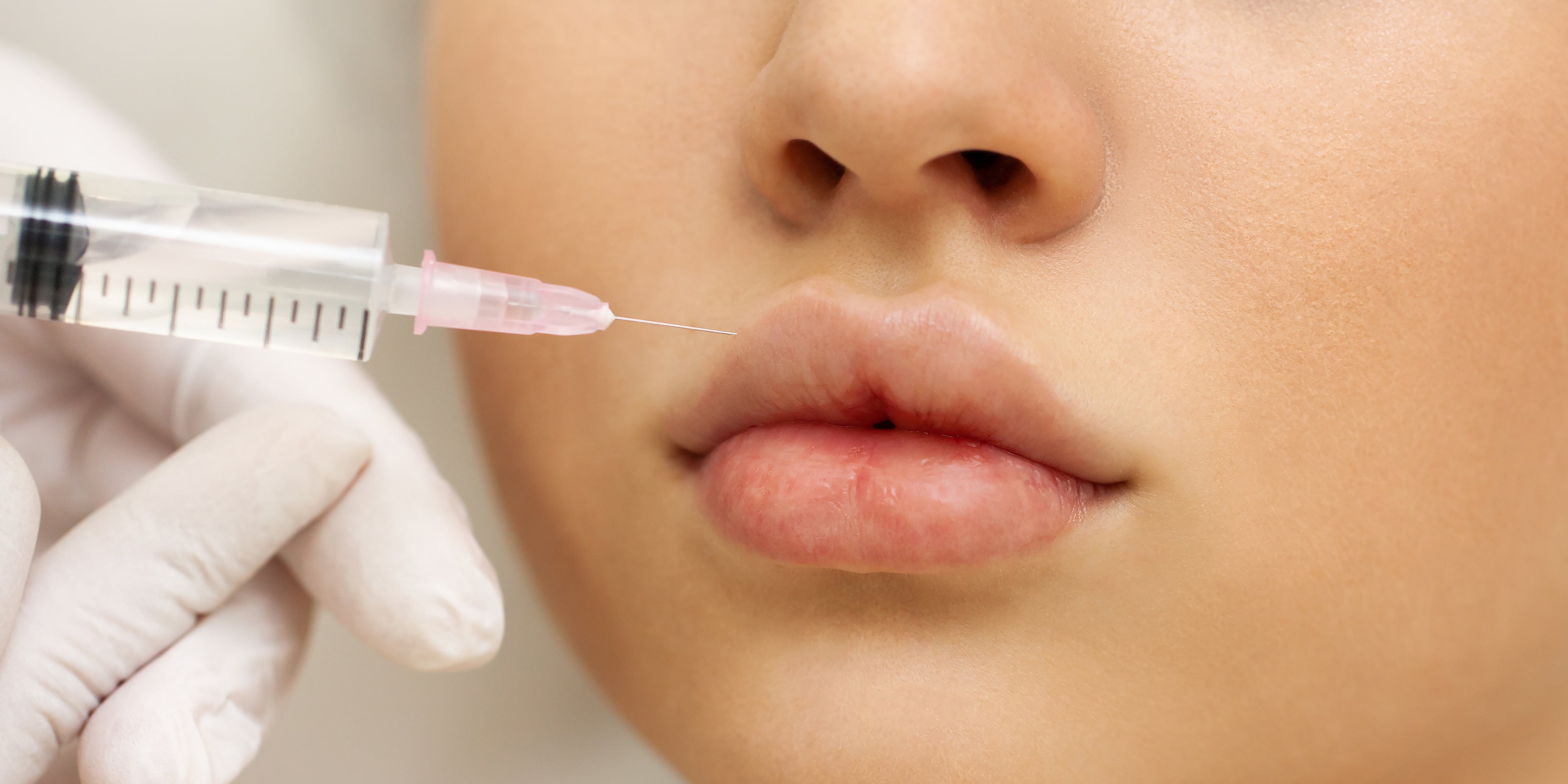 Keyhole Lip Filler: Before-and-Afters, Costs, Risks | POPSUGAR Beauty