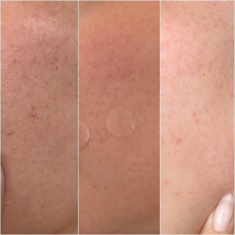 Best Acne Patches, According to PS Editors | PS Beauty