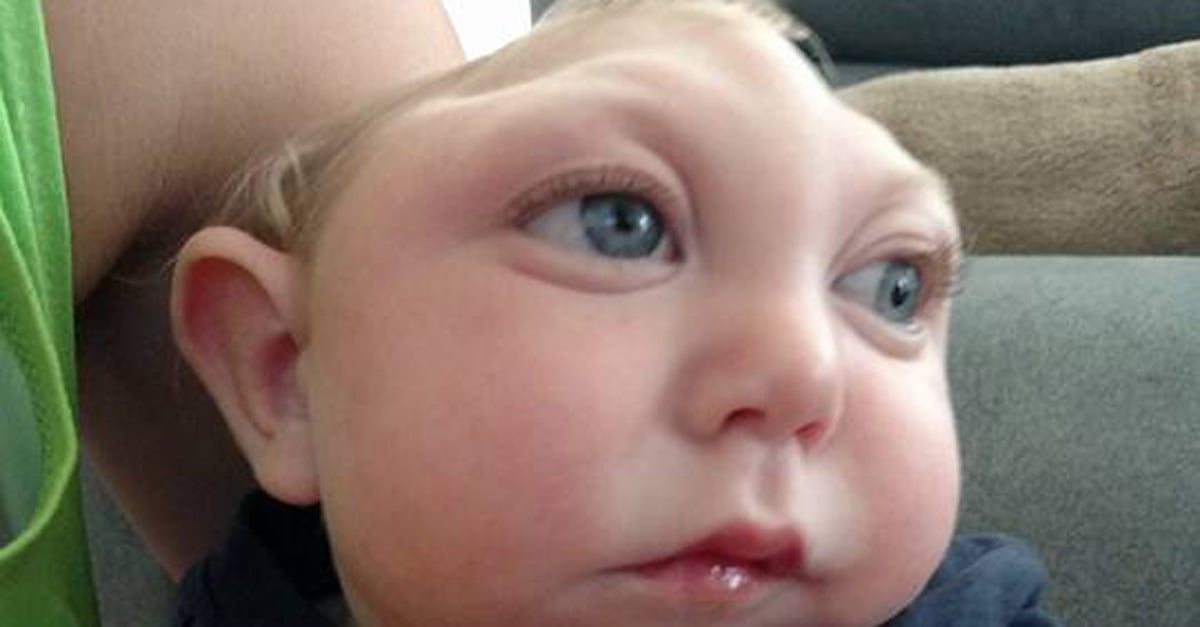 Baby Born Missing Most of His Skull Celebrates Birthday | PS Family