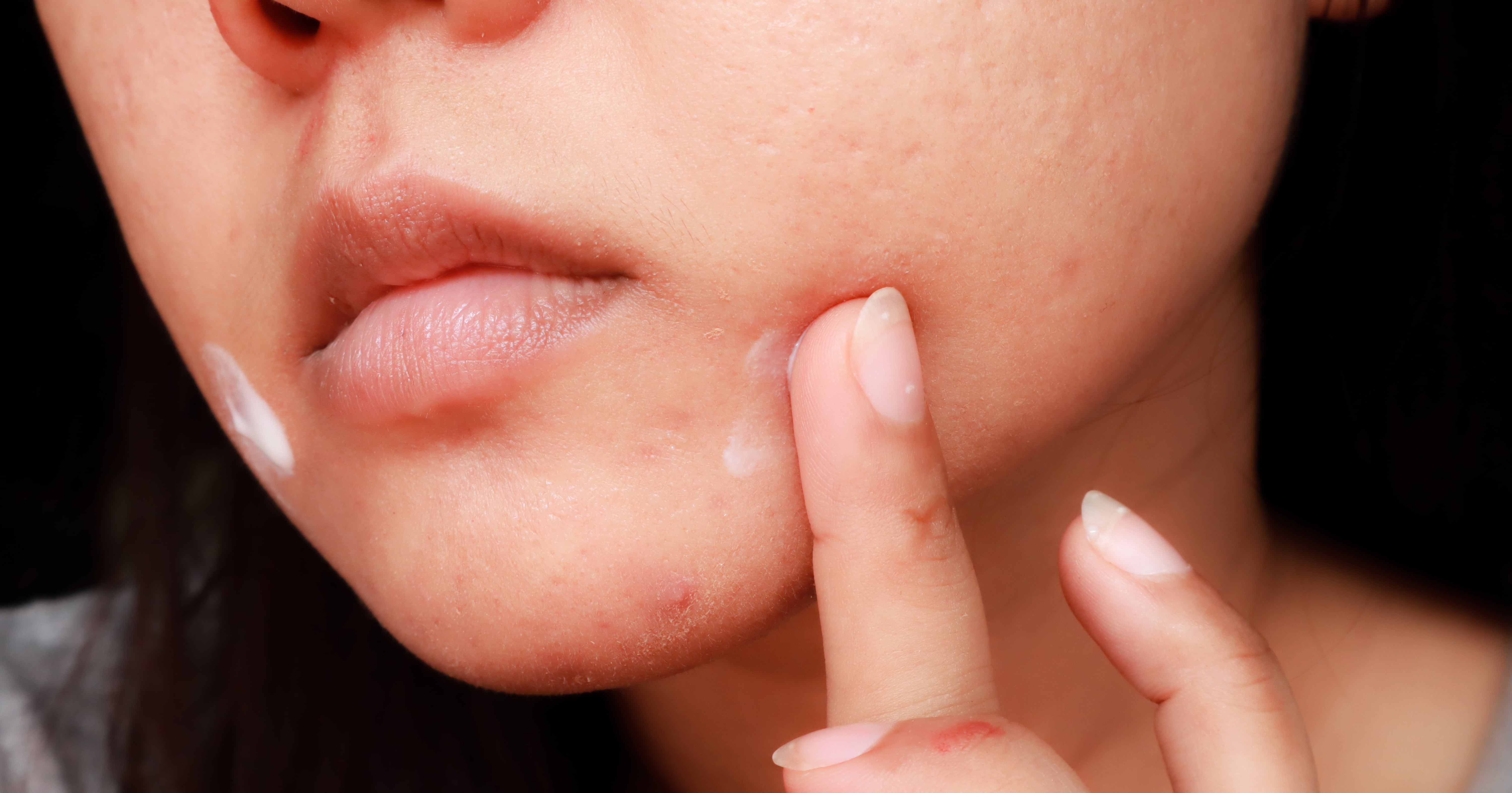 What Is Benzoyl Peroxide? | PS Beauty