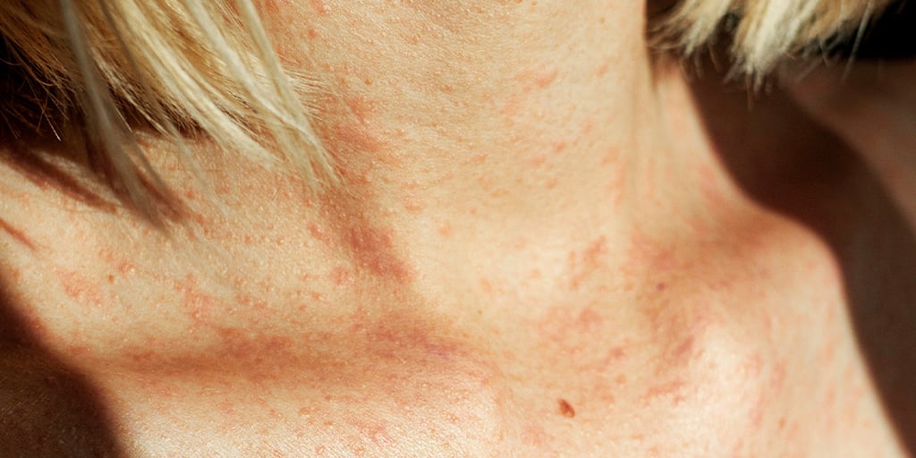 Hives vs. Rash: Experts Explain the Differences | PS Beauty