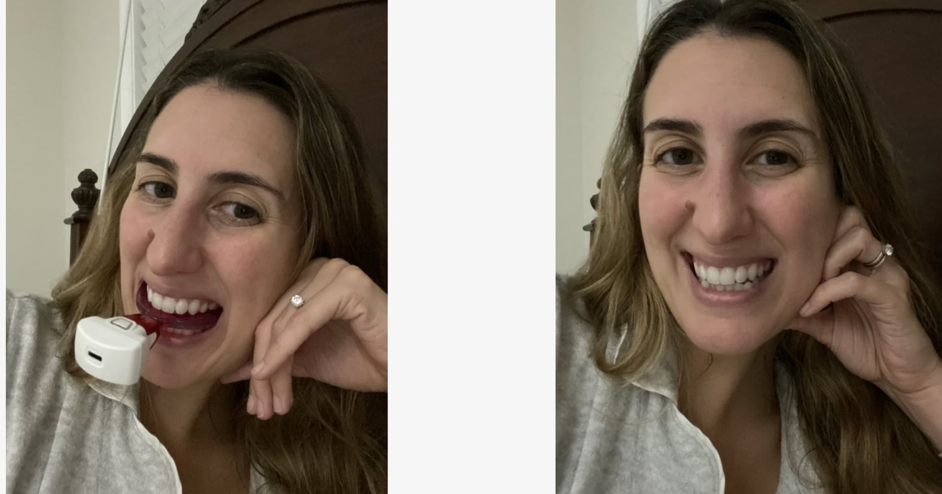 Byte Invisible Aligners Cost and Review | PS Beauty