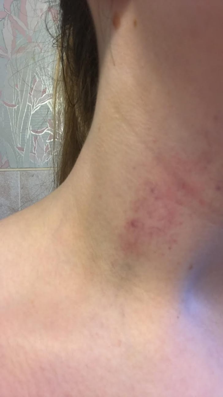 Before | How to Get Rid of a Hickey | POPSUGAR Beauty Photo 2