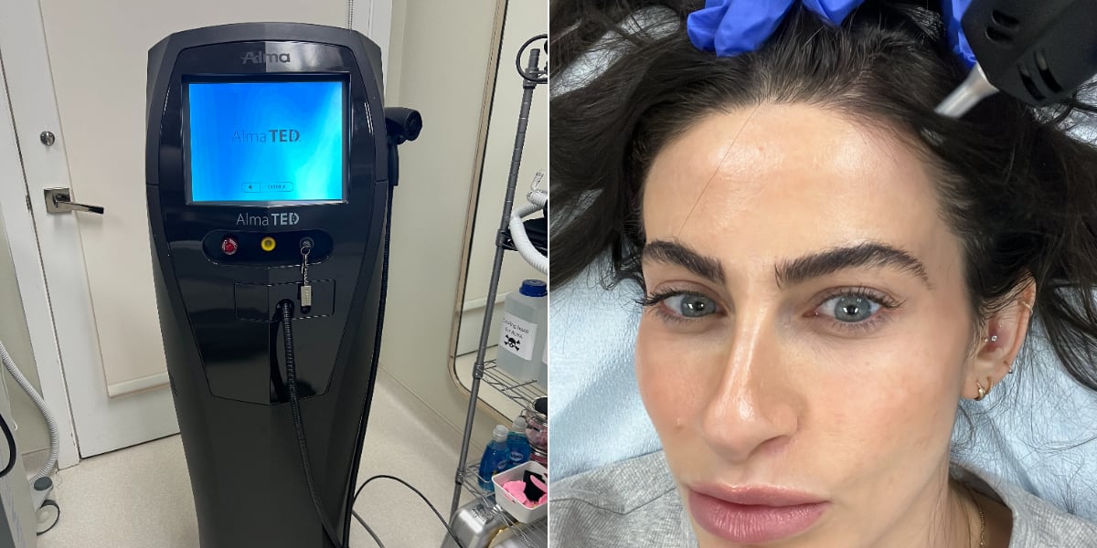 Alma TED Hair Treatment Review and Photos | PS Beauty