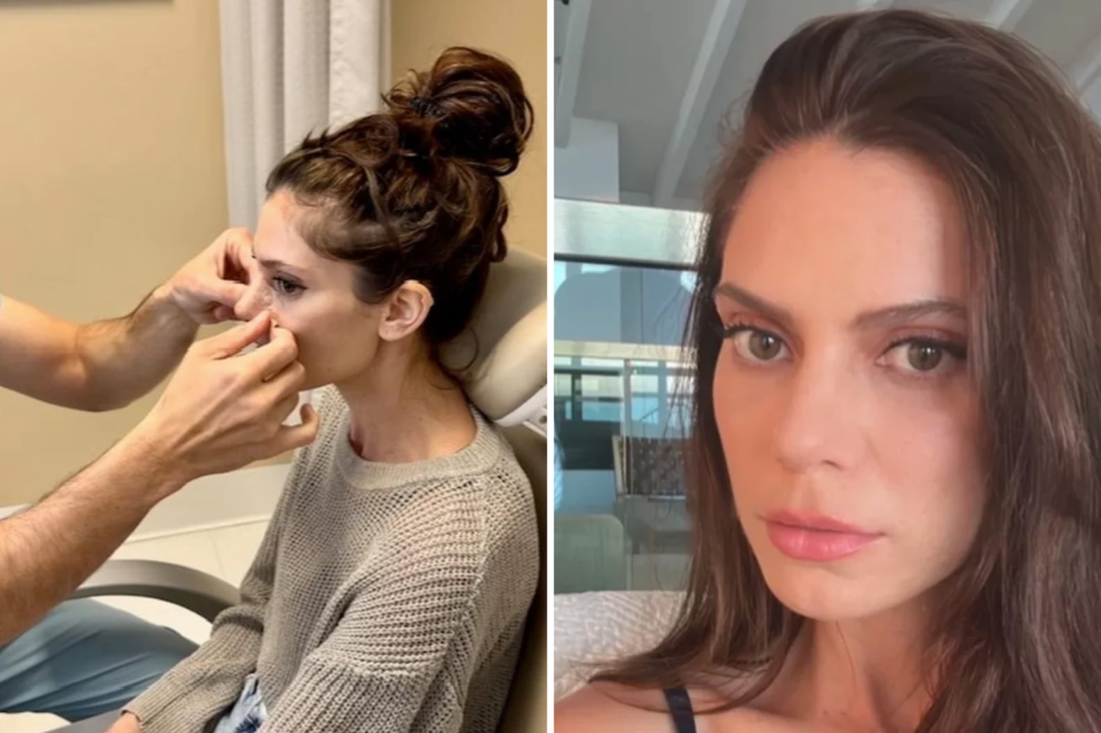 I Got a Baby Rhino, a Subtler Nose Job: See Photos | PS Beauty