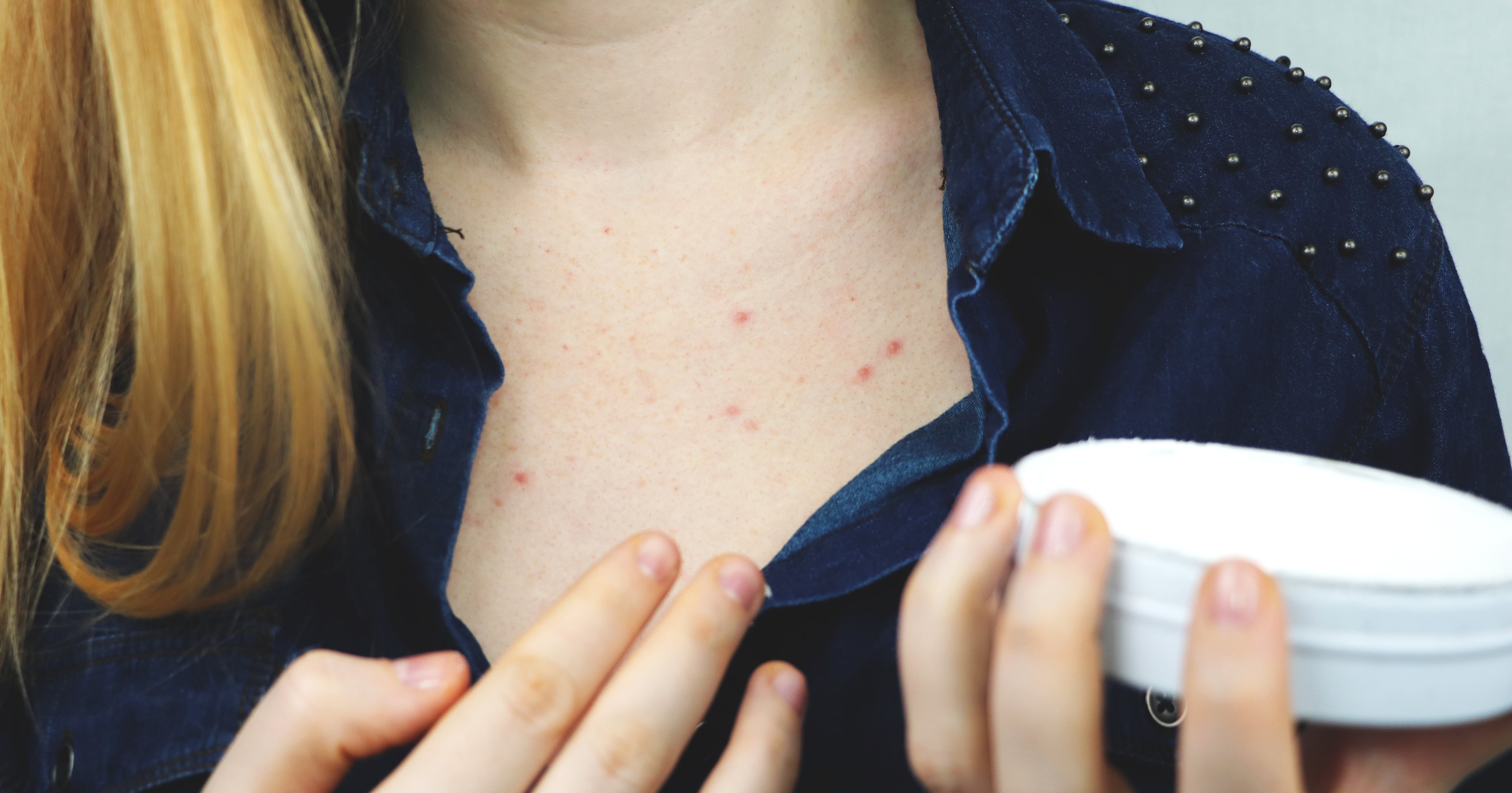 How to Treat Chest Acne, According to Dermatologists | PS Beauty