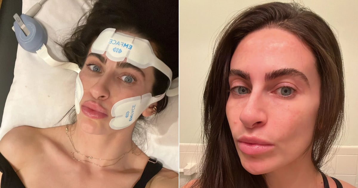 I Tried Emface, the Needle-less Skin Treatment - TodaysChronic I Tried Emface, the Needle-less Skin Treatment - TodaysChronic