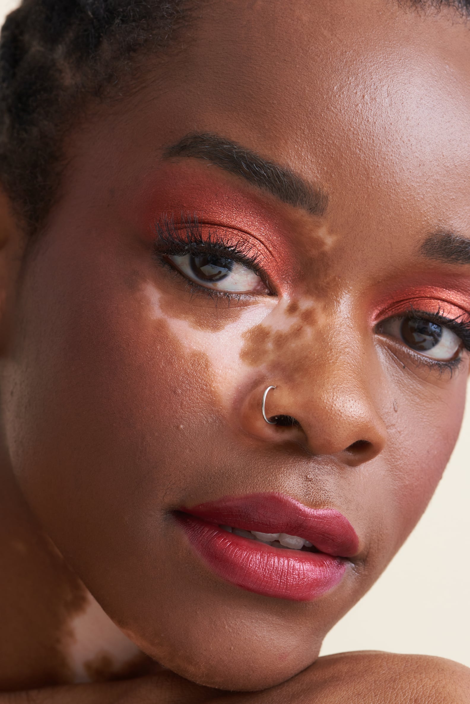Vitiligo Skin Condition Causes and Treatments | PS Beauty