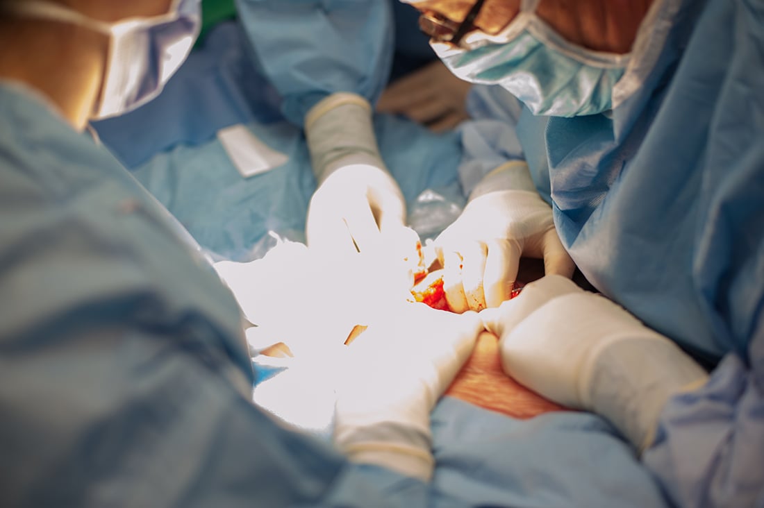 Delivery Of Baby C Section