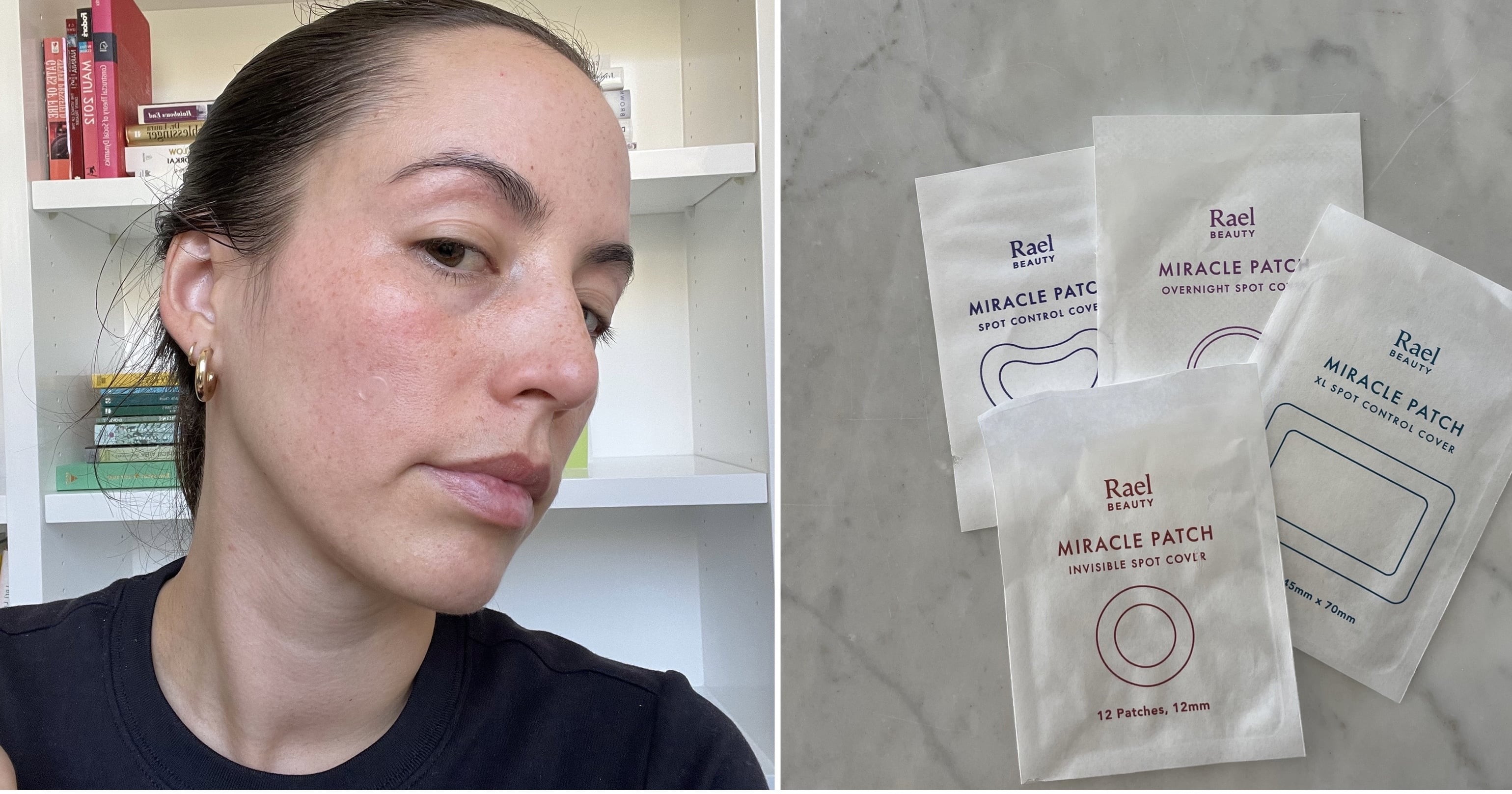 Rael Ultimate Pimple Patch Kit Review With Photos | POPSUGAR Beauty