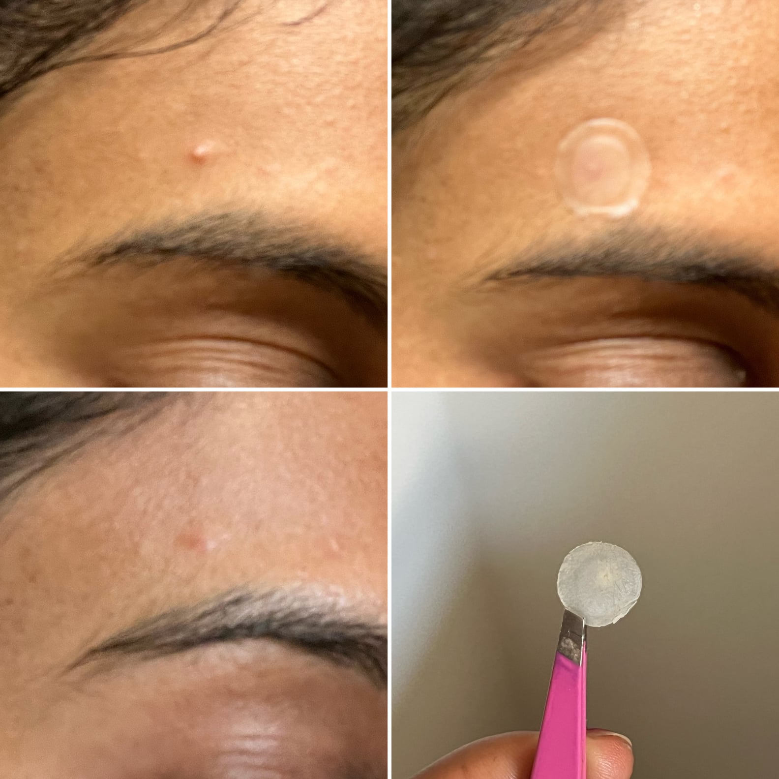 Good Molecules Pimple Patch Review With Photos | PS Beauty