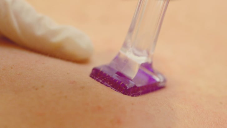 Back Facial For Acne | POPSUGAR Beauty