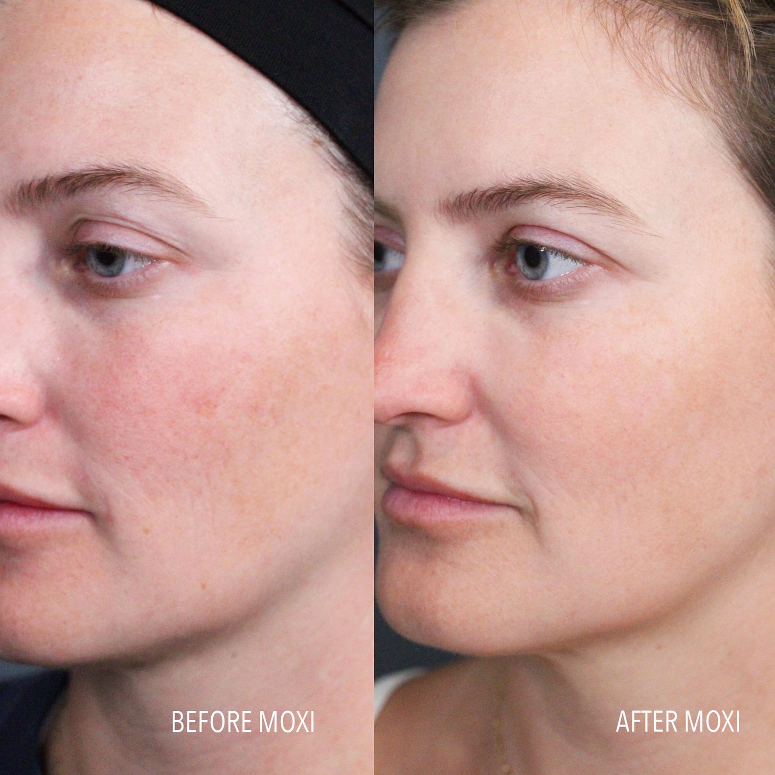 I Tried the Moxi Laser Treatment: See Photos | PS Beauty