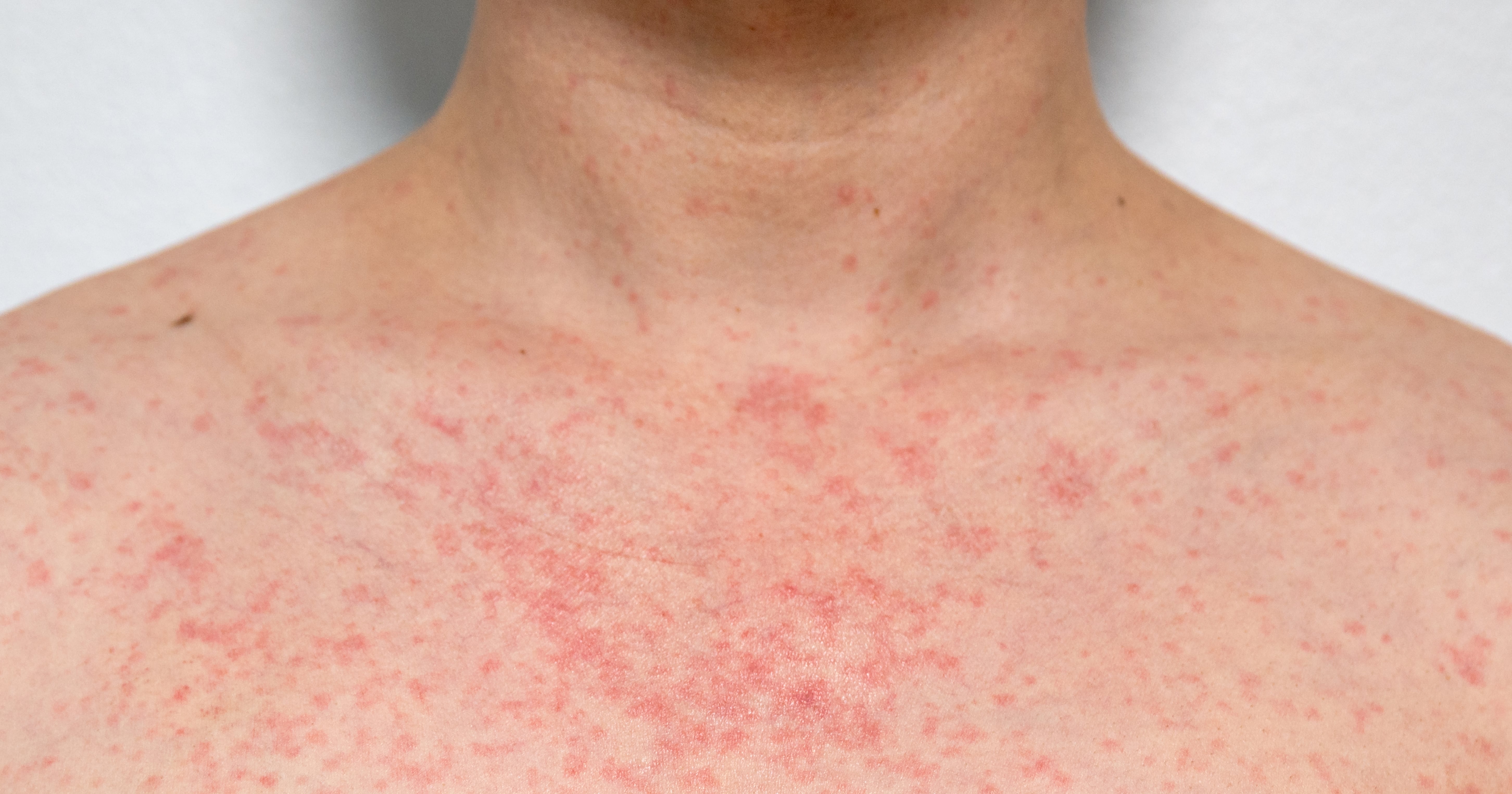 What Is Heat Rash Dermatologists Explain The Causes Ps Beauty