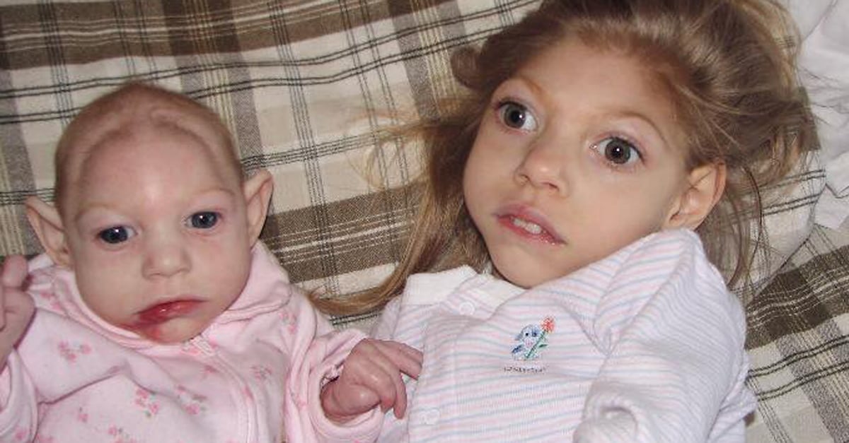 Baby Born With Zika-Linked Microcephaly | PS Family