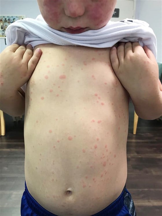 Mom Warns Parents About Rocky Mountain Spotted Fever | POPSUGAR Family