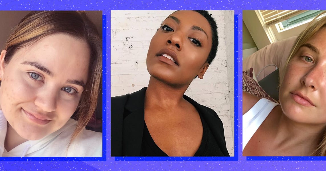 Editor Acne Confessions, Personal Experiences With Breakouts | PS Beauty