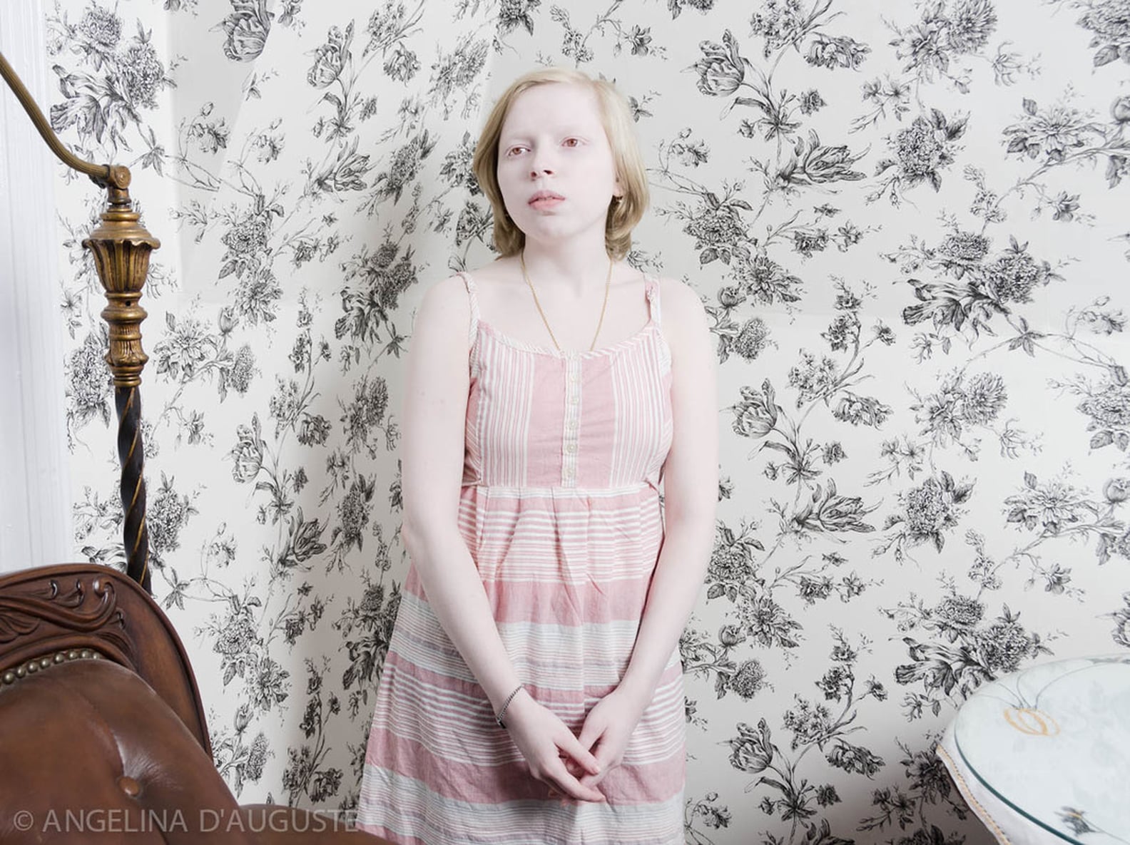 Albinism Photographs | PS Beauty