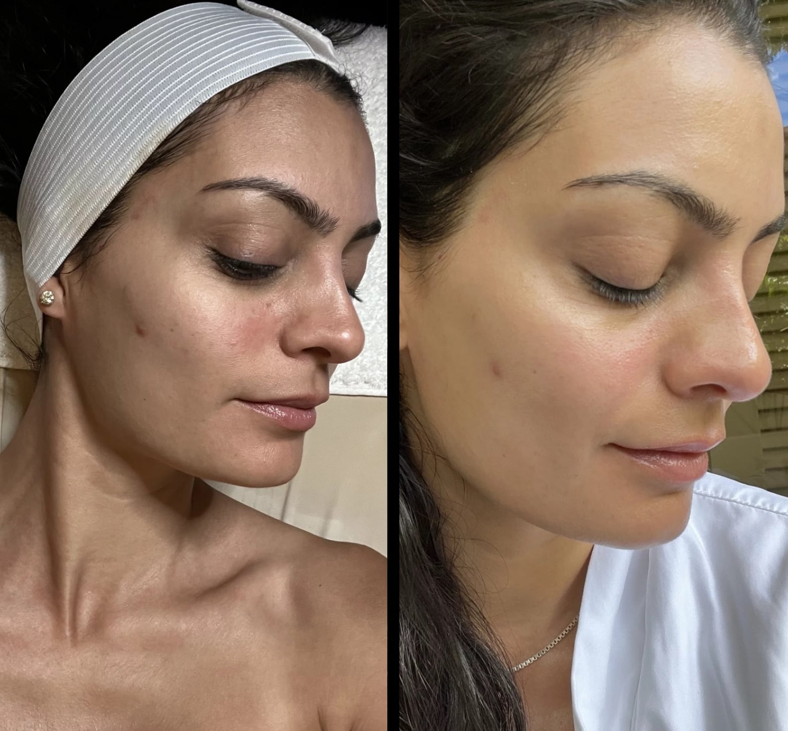 I Got a $500 Non-Surgical Lift Facial — Was It Worth It? | PS Beauty