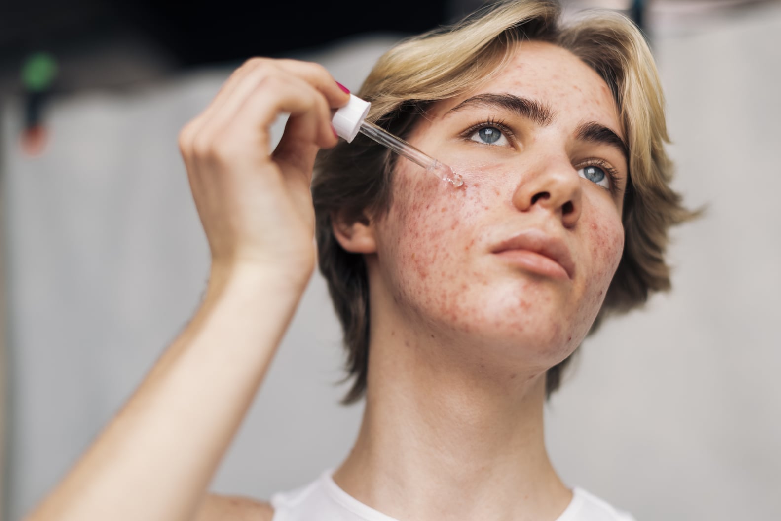 How to Treat Pimples Under the Skin, According to Derm | PS Beauty
