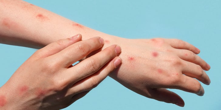 Is Monkeypox an STD? The Answer Is Complicated | POPSUGAR Fitness