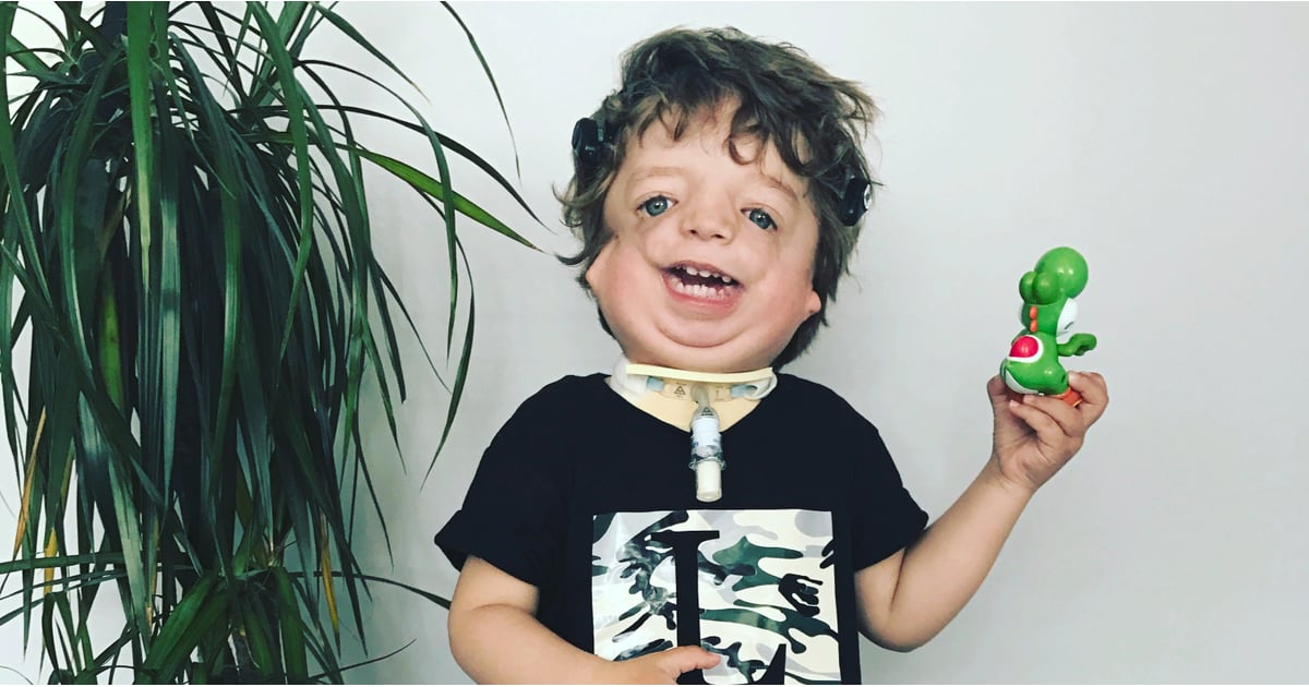 Baby Model With Facial Deformity | POPSUGAR Family