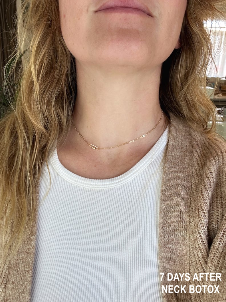 I Got Neck Botox: See Before and After Photos | PS Beauty