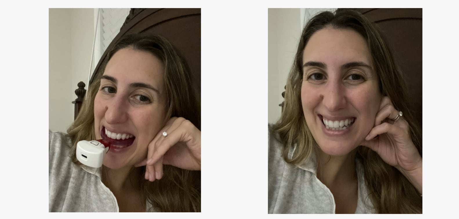 Byte Invisible Aligners Cost and Review | POPSUGAR Beauty
