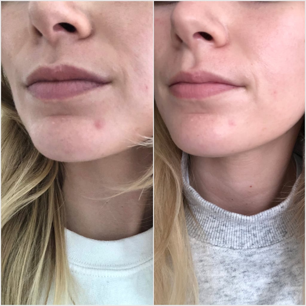 Dr Barbara Sturm Clarifying Spot Treatment Review POPSUGAR Beauty