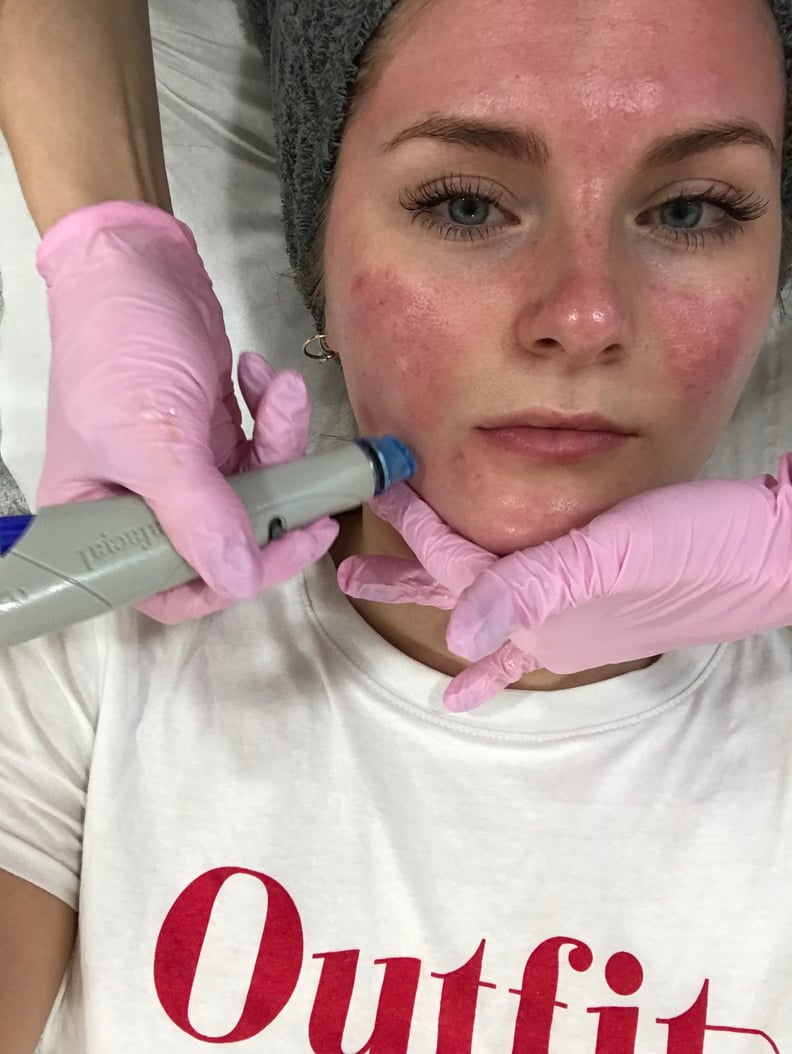 How to Treat Broken Capillaries on the Face | PS UK Beauty