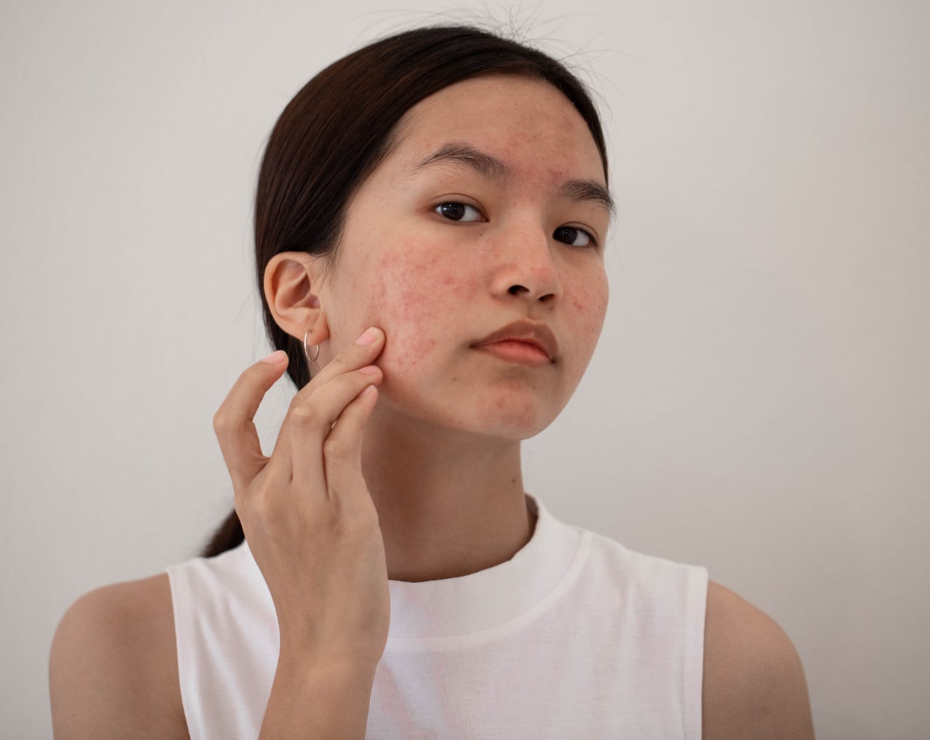 Stress Acne: Causes, Treatments, & More From Dermatologists | PS Beauty