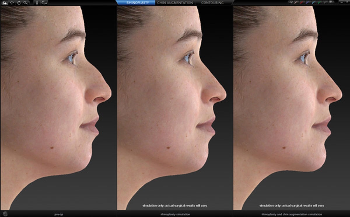 What is the VECTRA 3D Imaging System? | PS Beauty