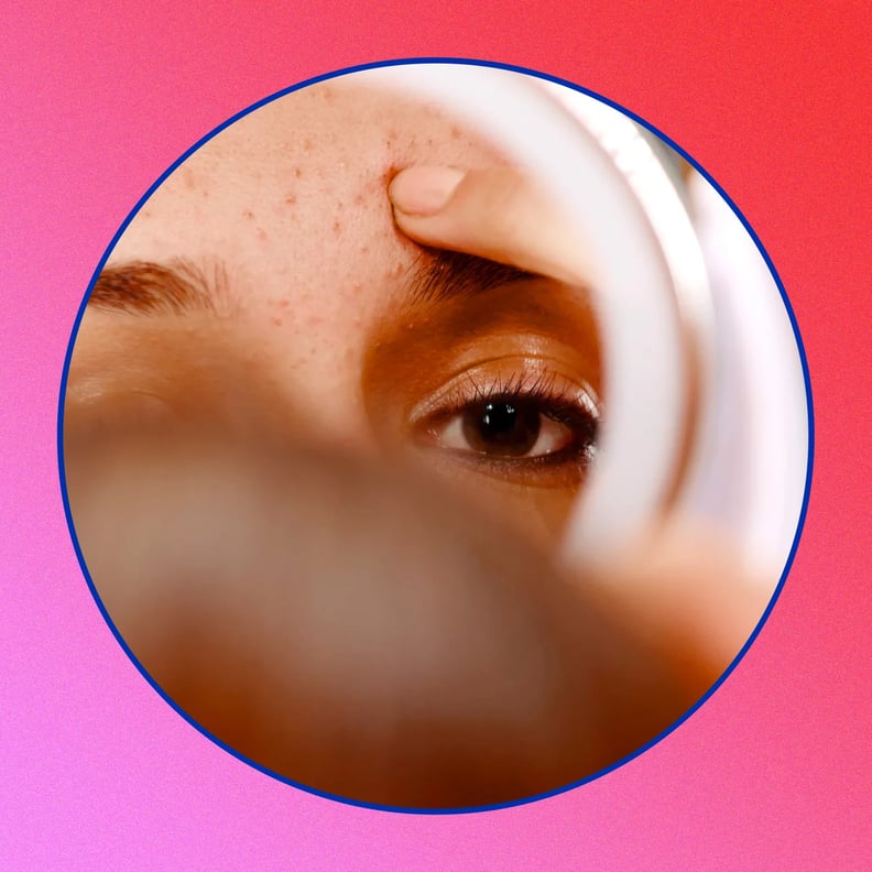 What Is Acne Excoriée? | PS Beauty