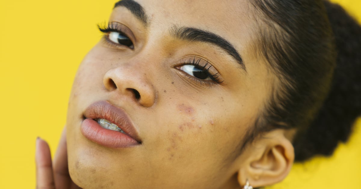 Acne Types: How to Identify and Treat Them | POPSUGAR Beauty