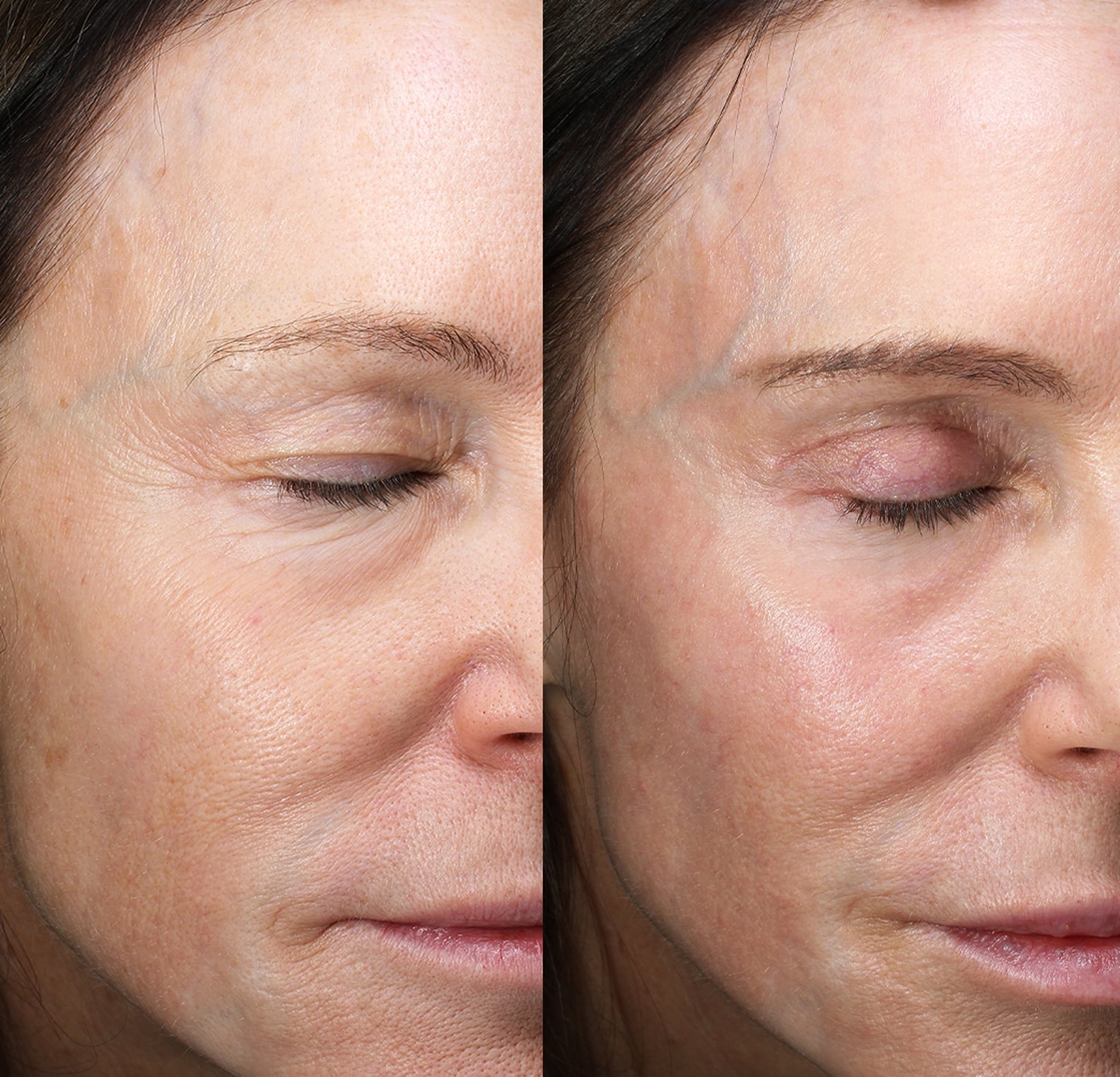 Are Nanofat Procedures the Future of Plastic Surgery? | PS Beauty