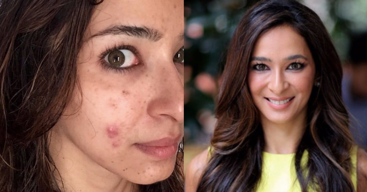 Dermatologist Takes Photo of Acne to Fight Stigma | PS Beauty