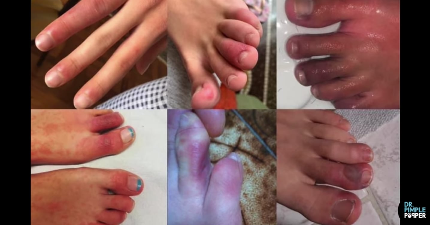 Can Coronavirus Cause Skin Rashes? Dermatologists Think So | PS Beauty