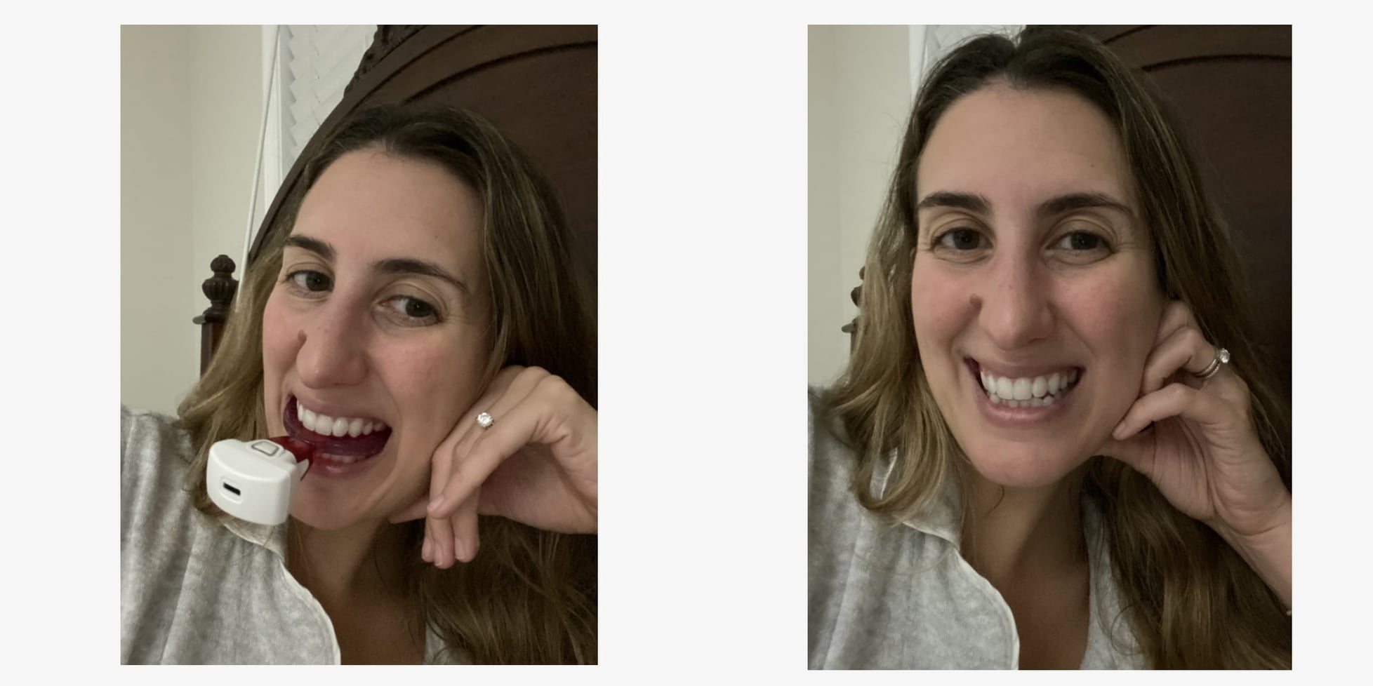 Byte Invisible Aligners Cost and Review | POPSUGAR Beauty