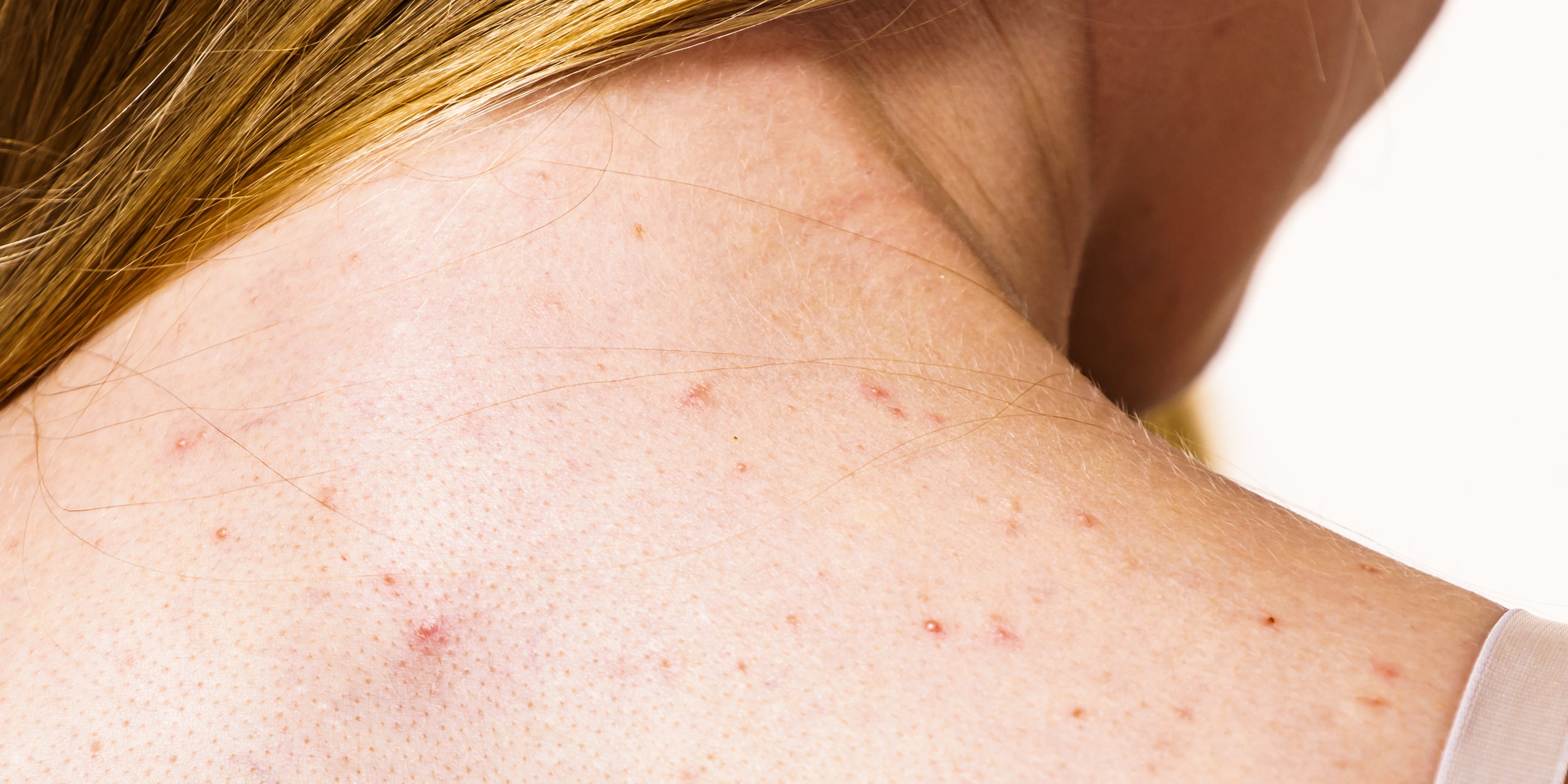 How to Get Rid of Back Acne: A Dermatologist Explains | POPSUGAR Beauty