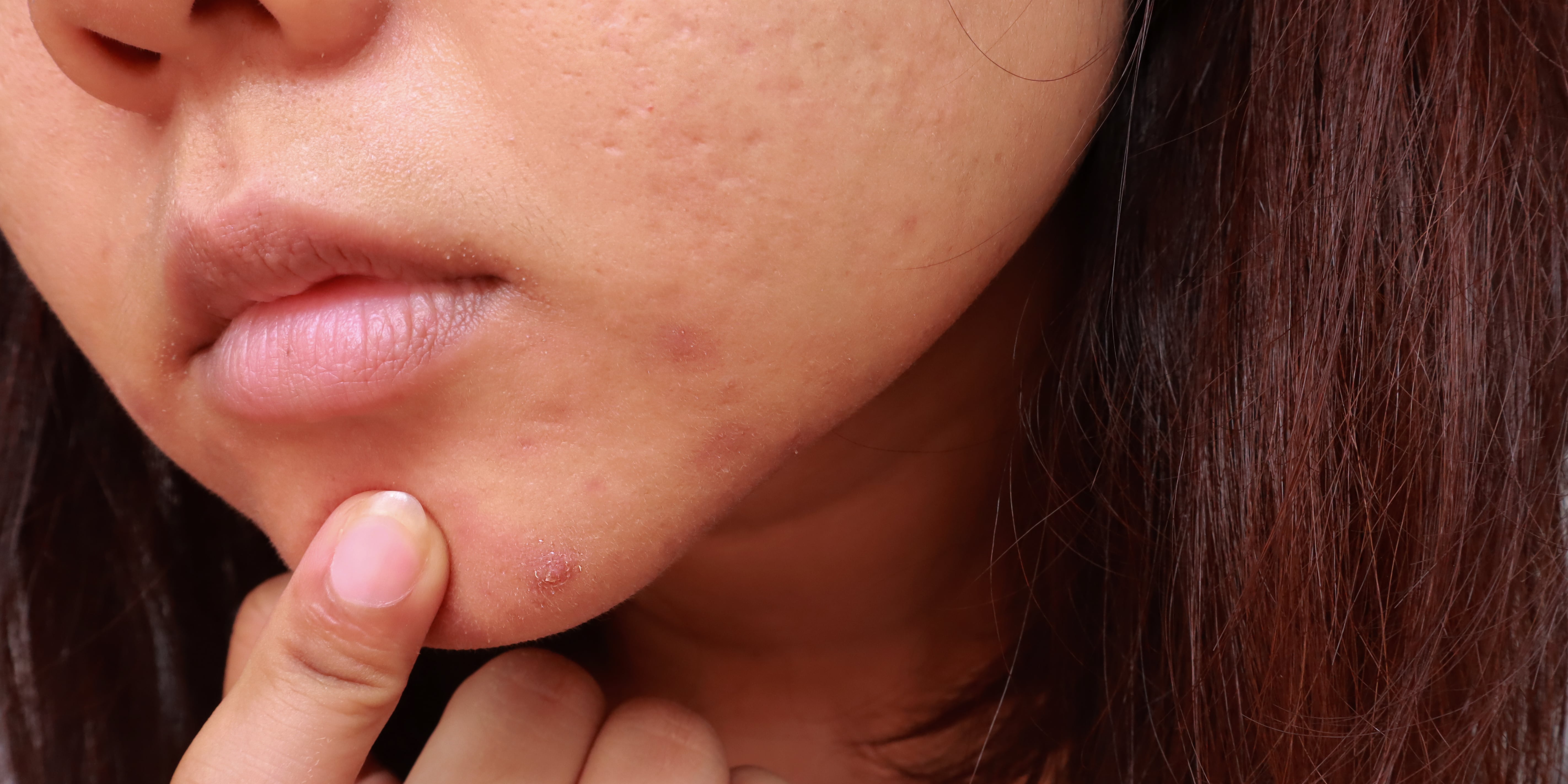What to Know About Treating Cystic Acne, Per Dermatologists | POPSUGAR ...
