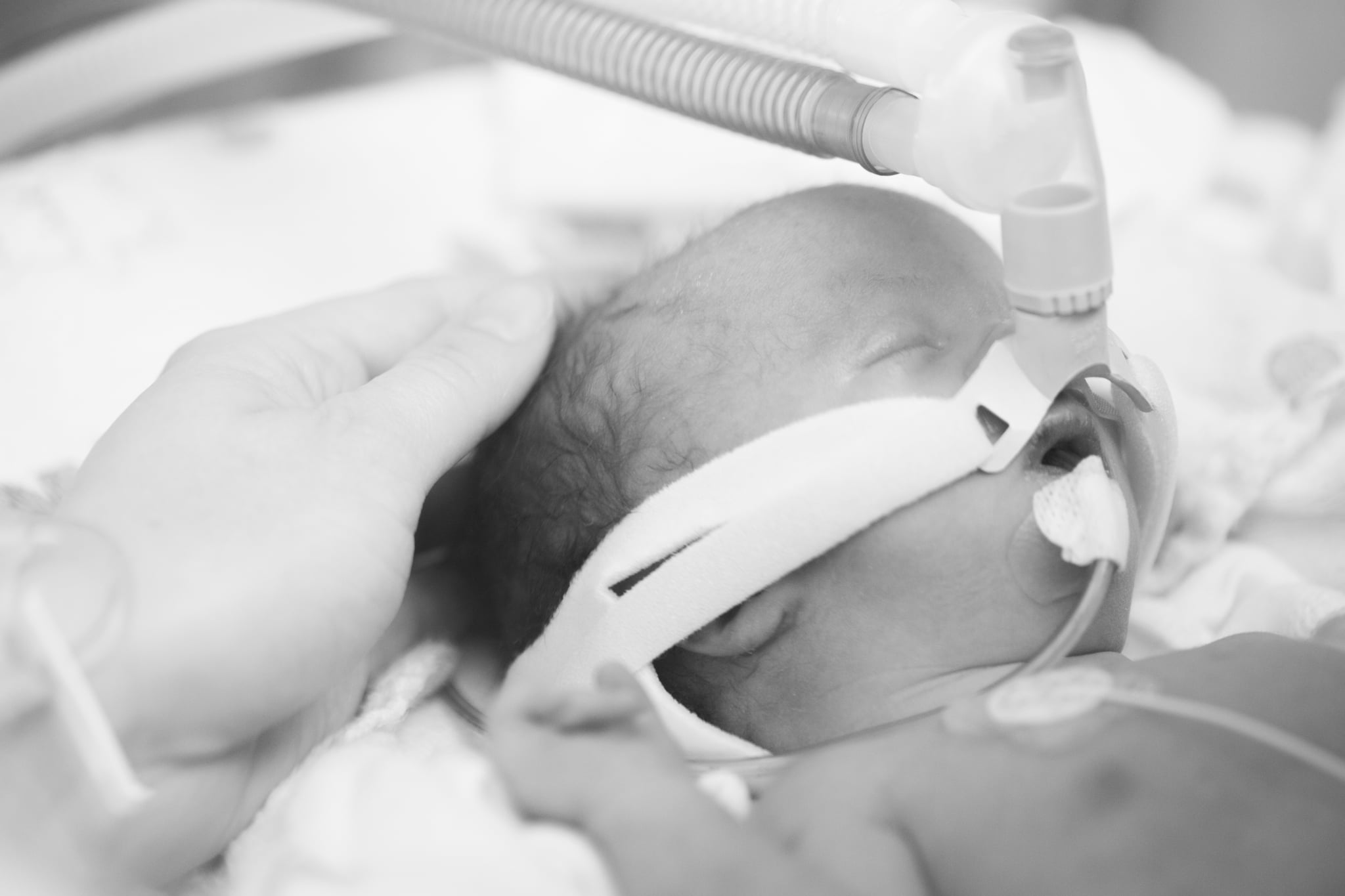 Trisomy 13 Baby