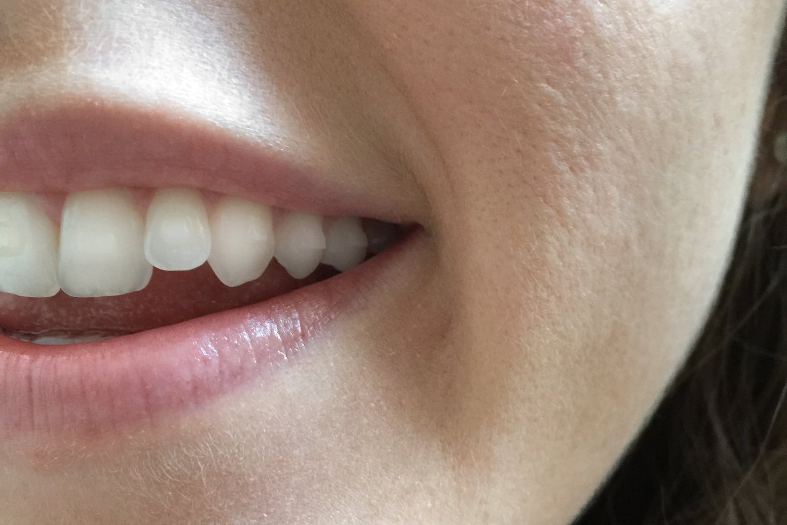 Pros and Cons of Invisalign | POPSUGAR Beauty