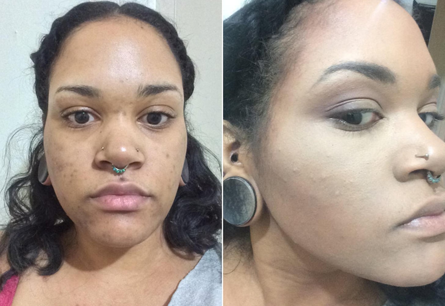 Color-Correcting Acne Scars Before and After | PS Beauty