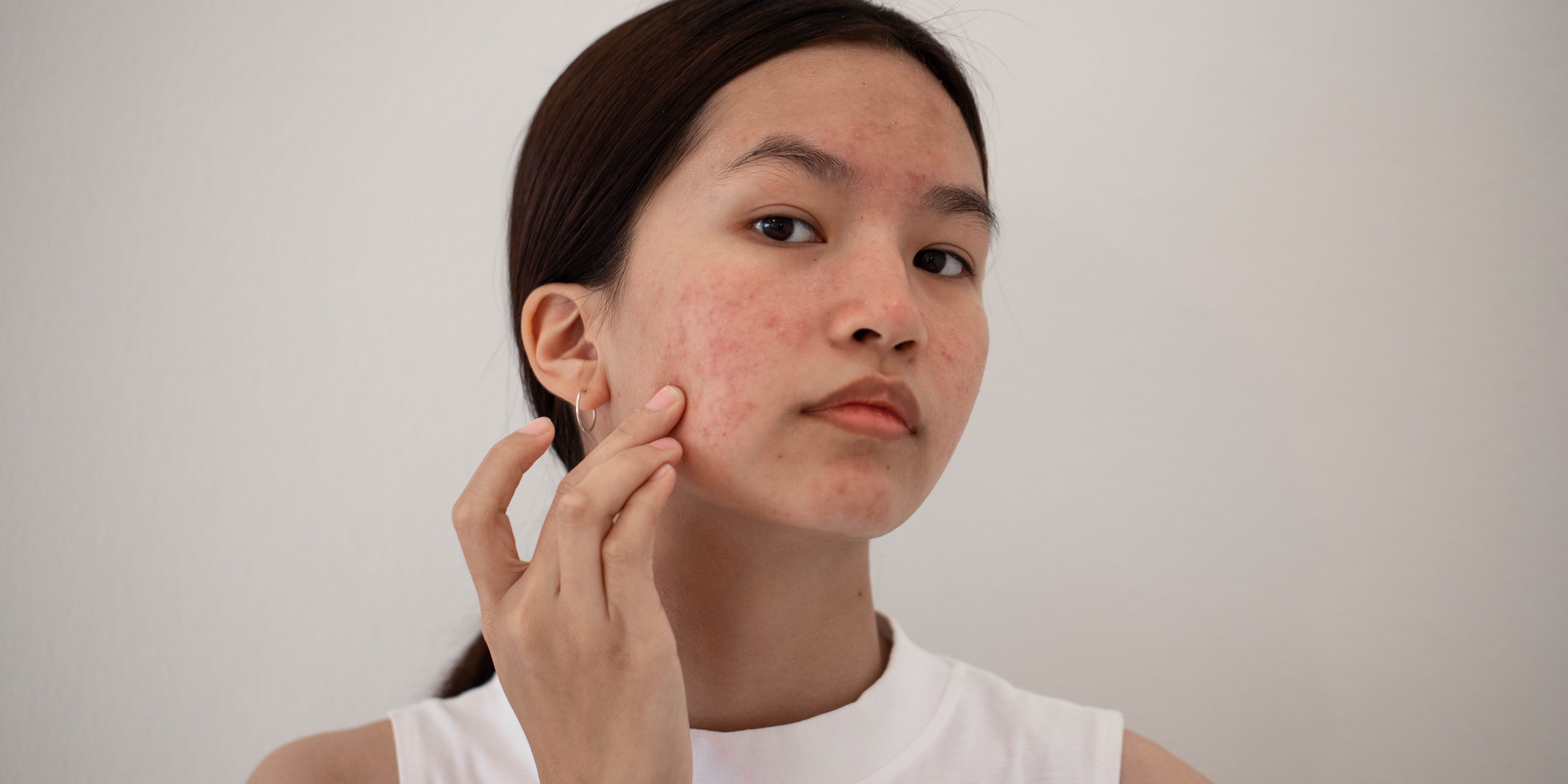 Stress Acne: Causes, Treatments, & More From Dermatologists | PS Beauty