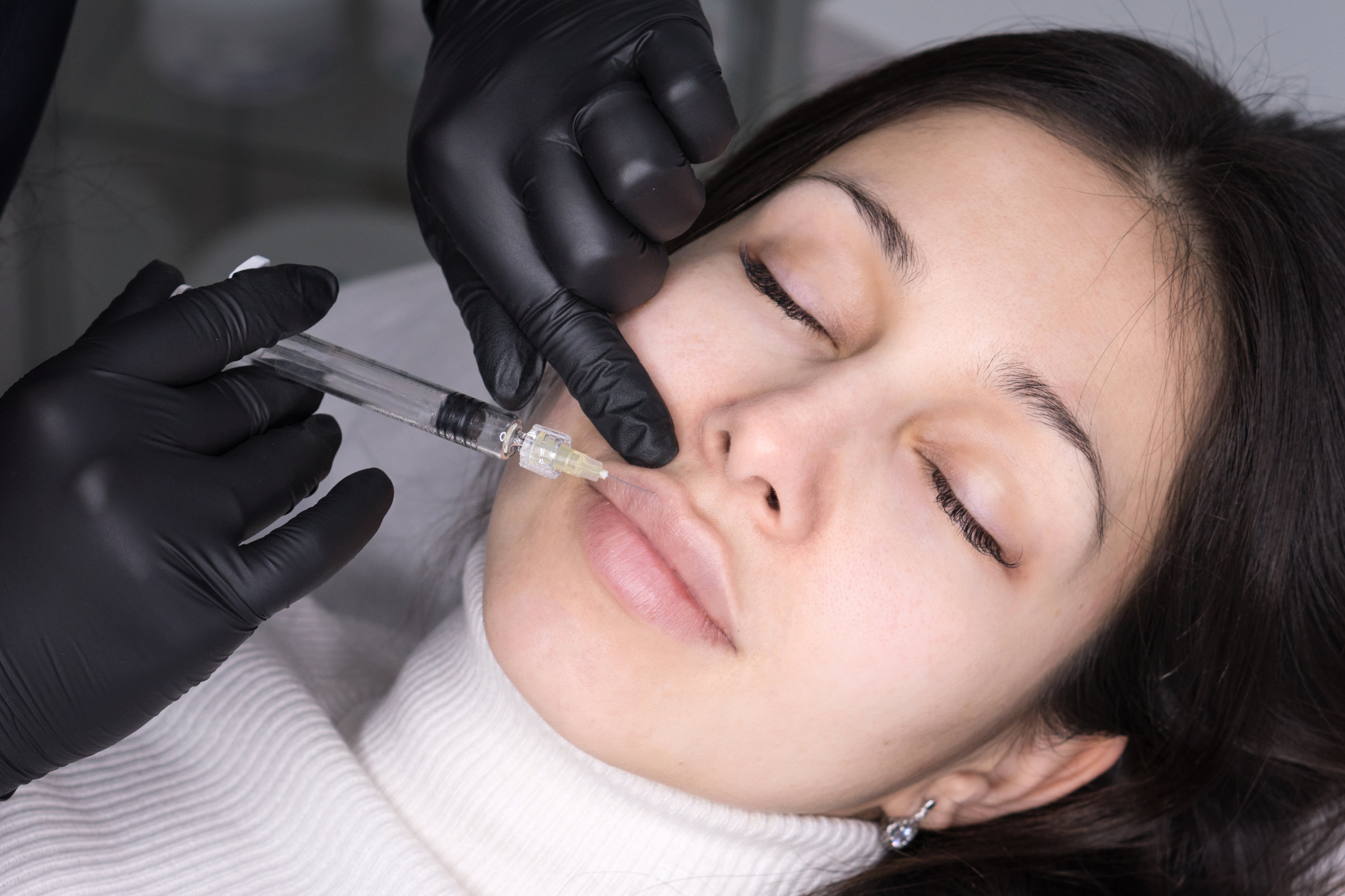 Lip Filler Migration: What Is It? How to Get Rid of It? | POPSUGAR Beauty