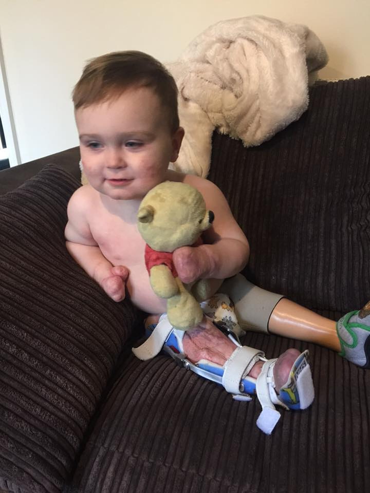 Boy With Amputations From Meningitis Takes First Steps | PS Family